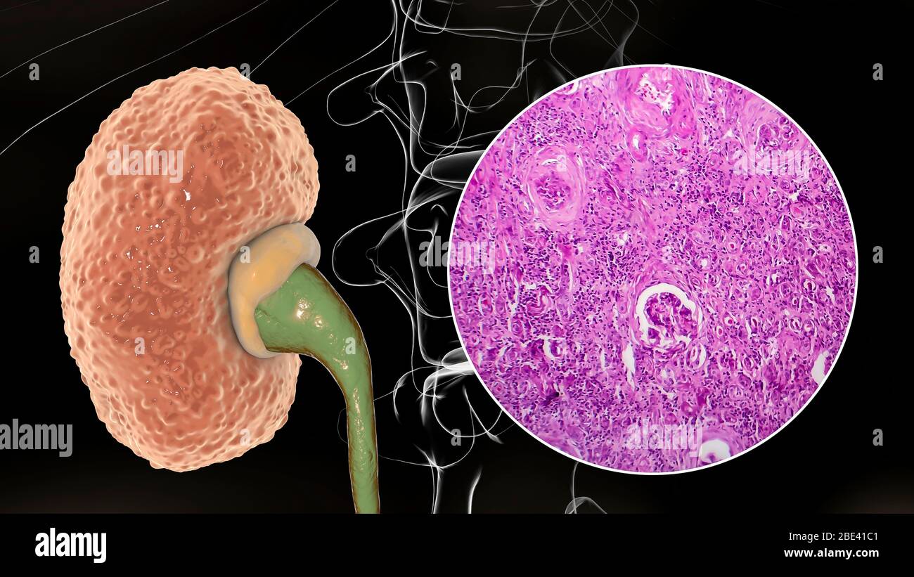 Chronic kidney disease, computer illustration and light micrograph. The ...