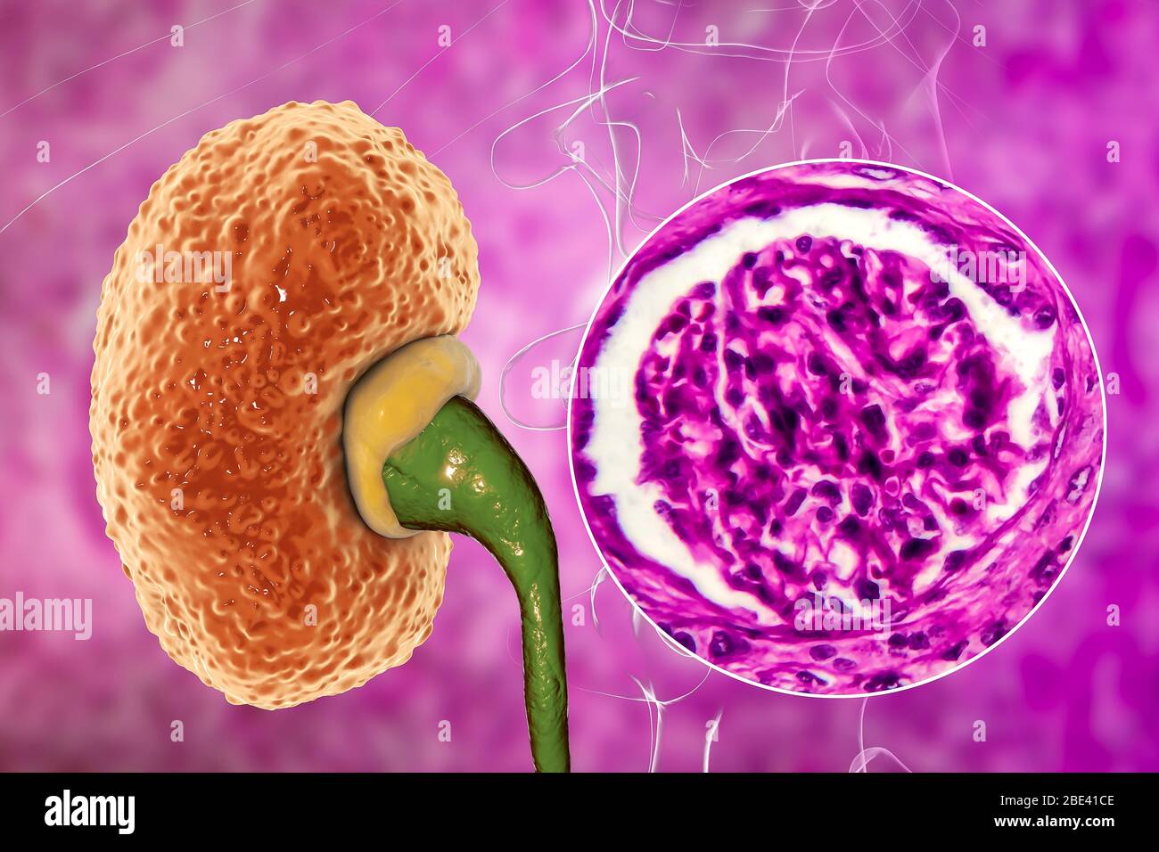 Chronic kidney disease, computer illustration and light micrograph. The ...