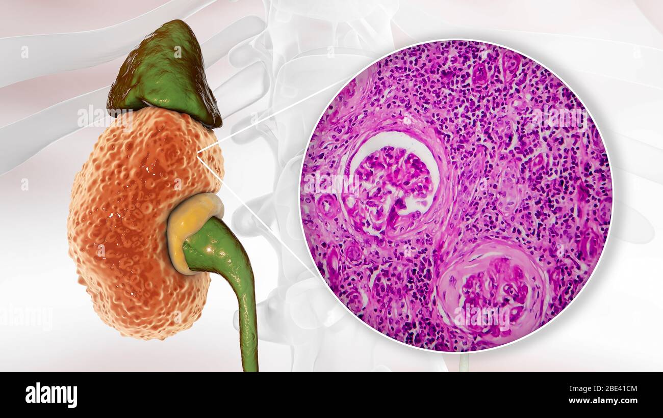 Chronic kidney disease, computer illustration and light micrograph. The ...