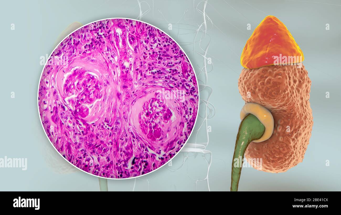 Chronic kidney disease, computer illustration and light micrograph. The ...