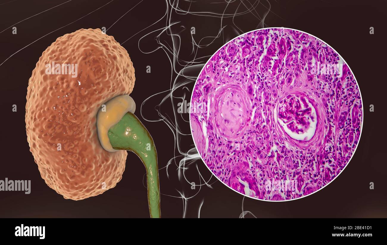 Chronic kidney disease, computer illustration and light micrograph. The ...