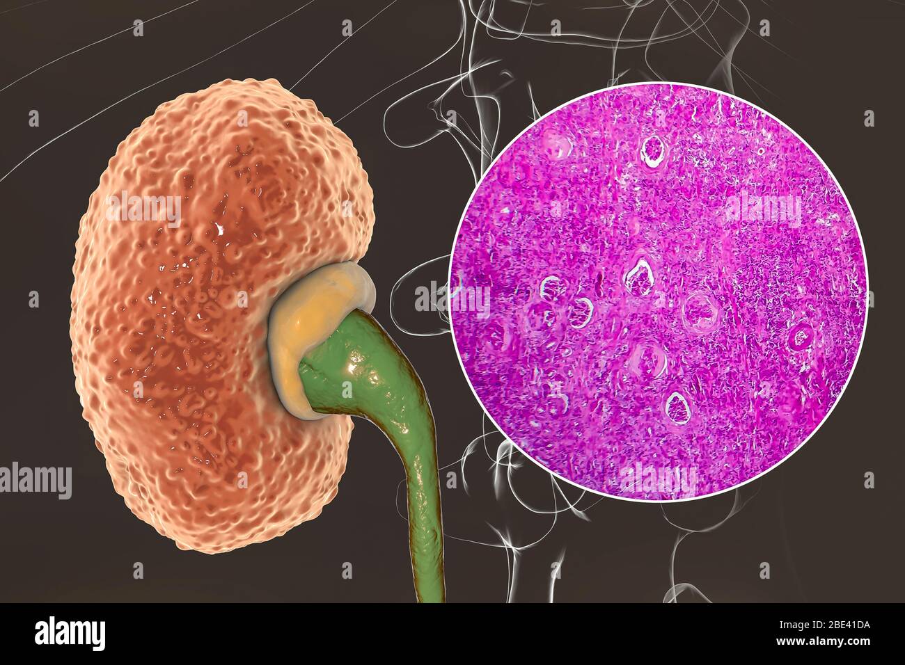 Chronic kidney disease, computer illustration and light micrograph. The ...