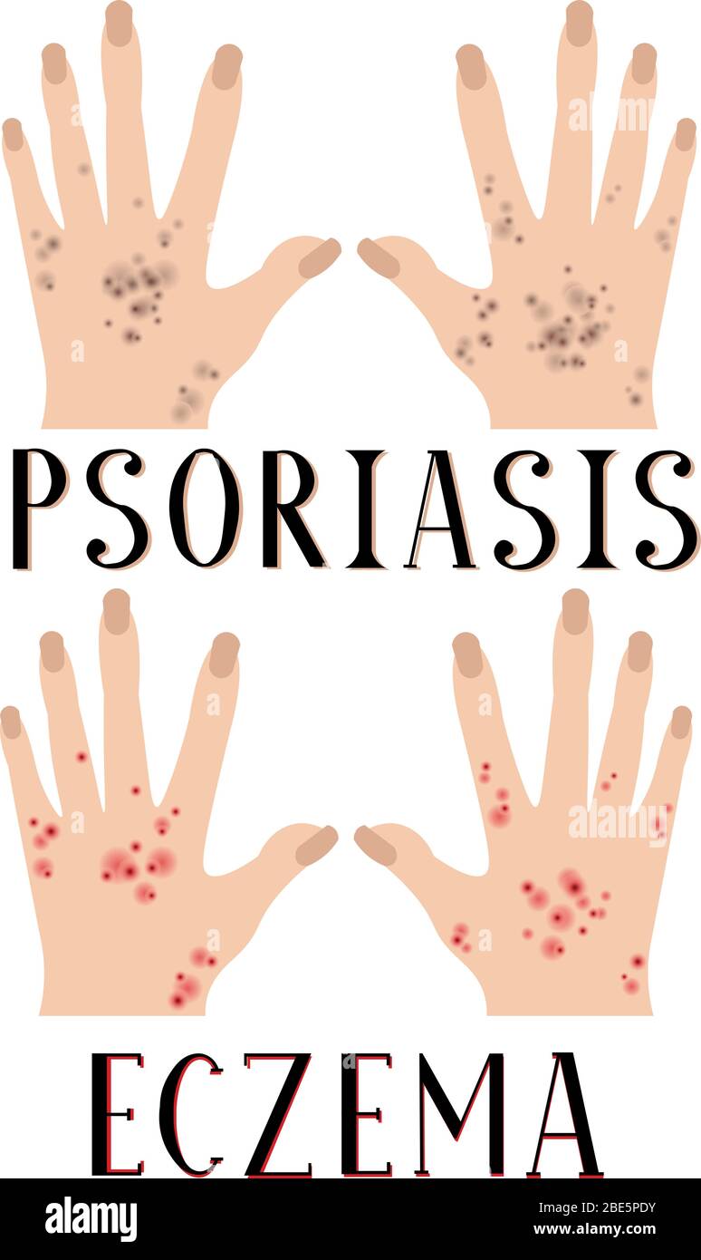 Eczema vector vectors hi-res stock photography and images - Alamy