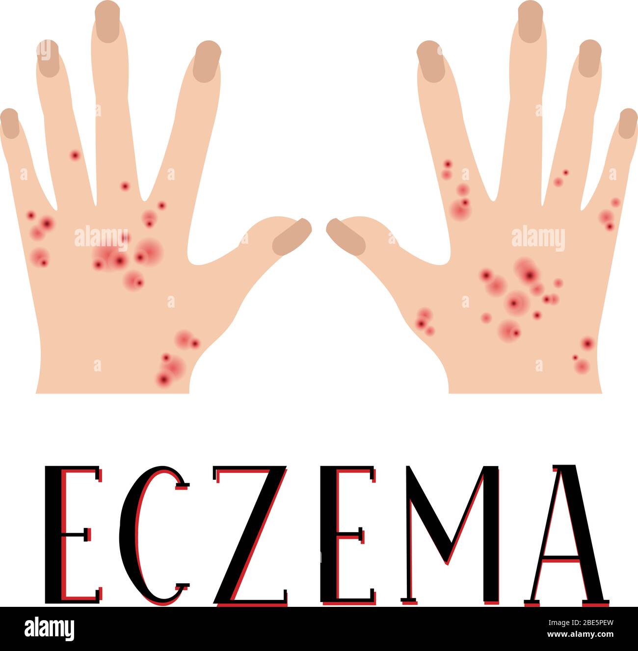 Eczema vector vectors hi-res stock photography and images - Alamy