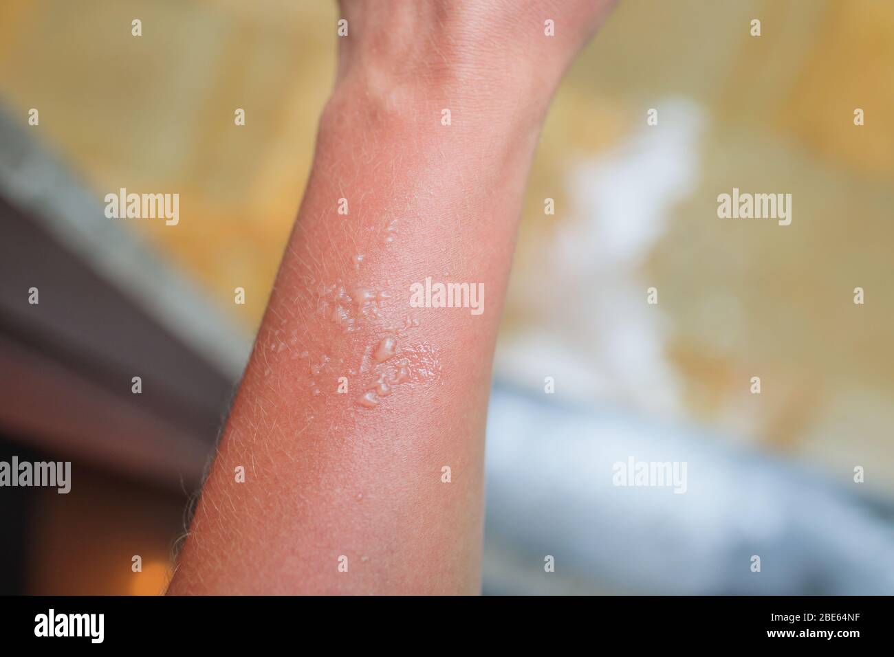 Left Arm Pain High Resolution Stock Photography and Images - Alamy