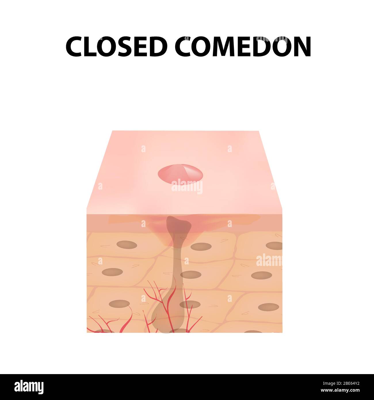 Closed comedones. Acne on the skin. Dermatological and cosmetic ...