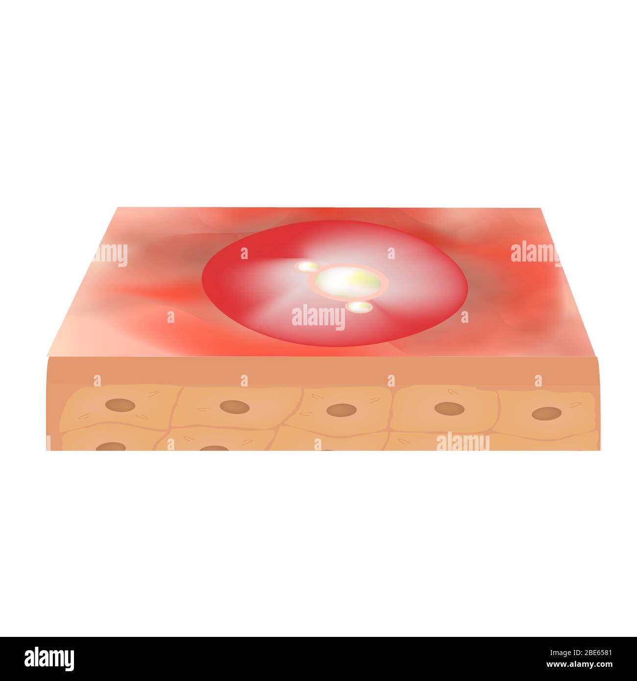 Cysts acne Cut Out Stock Images & Pictures - Alamy