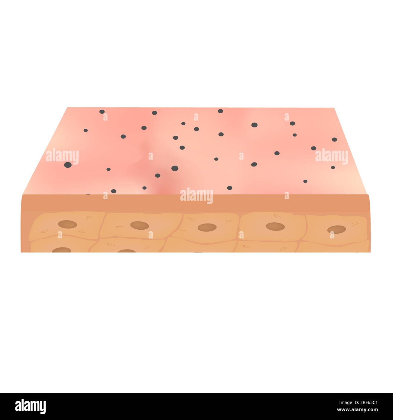 Diagram blackhead pimple illustration Cut Out Stock Images & Pictures ...