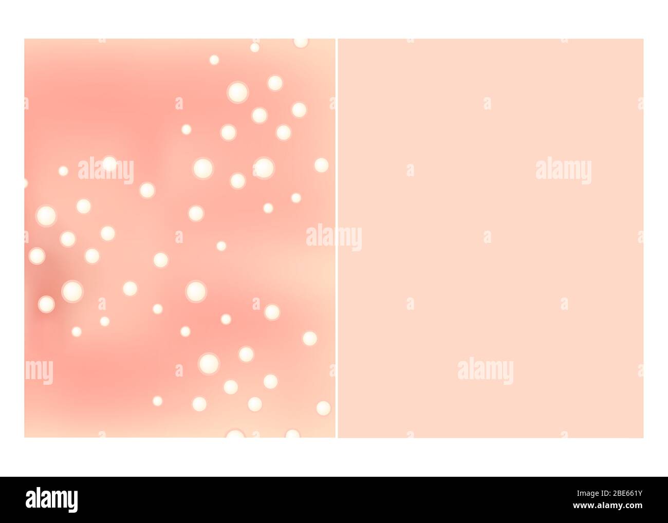 Texture, inflamed pimples and acne. Before After acne. Skin background ...