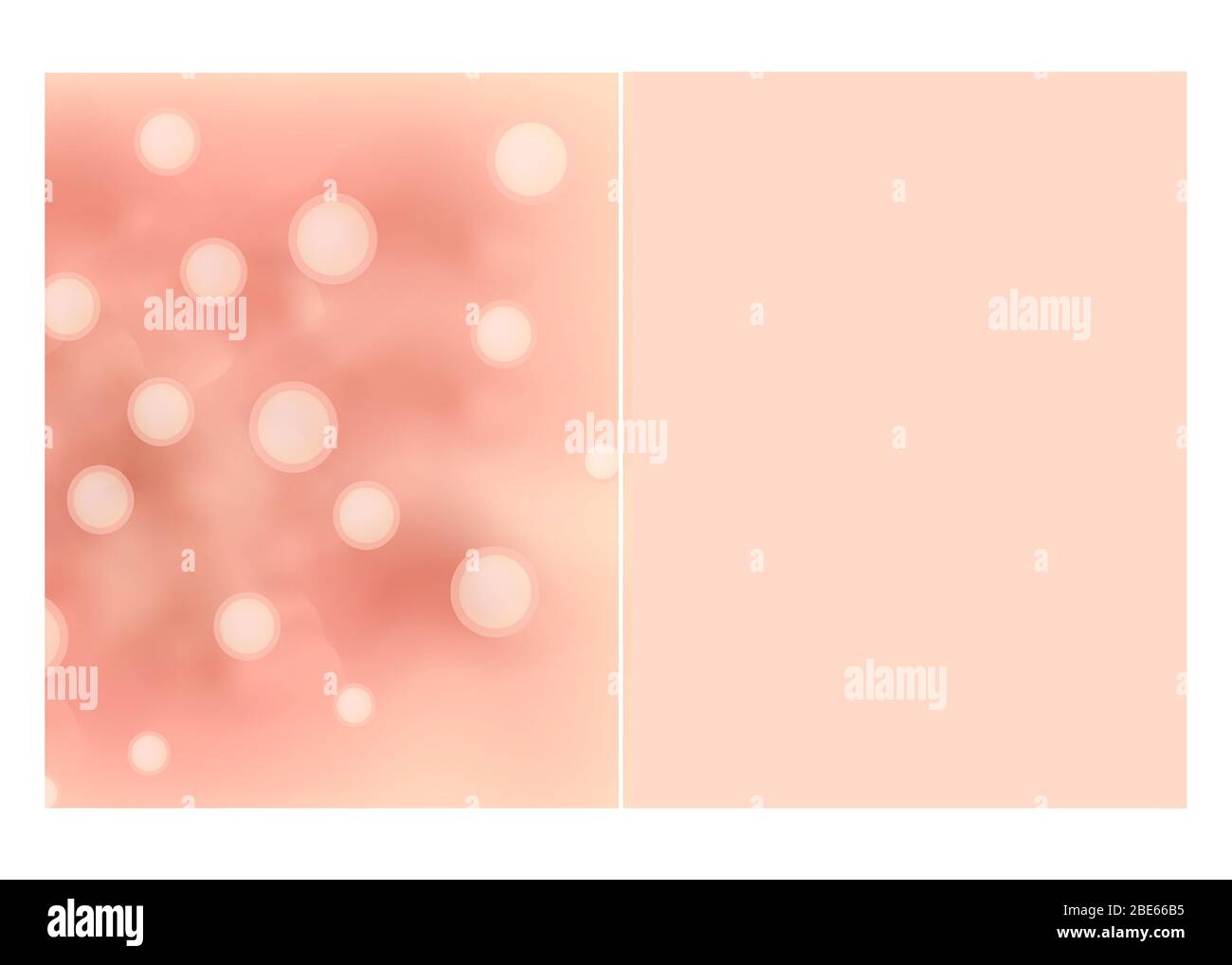 Texture, inflamed pimples and acne. Before After acne. Skin background ...