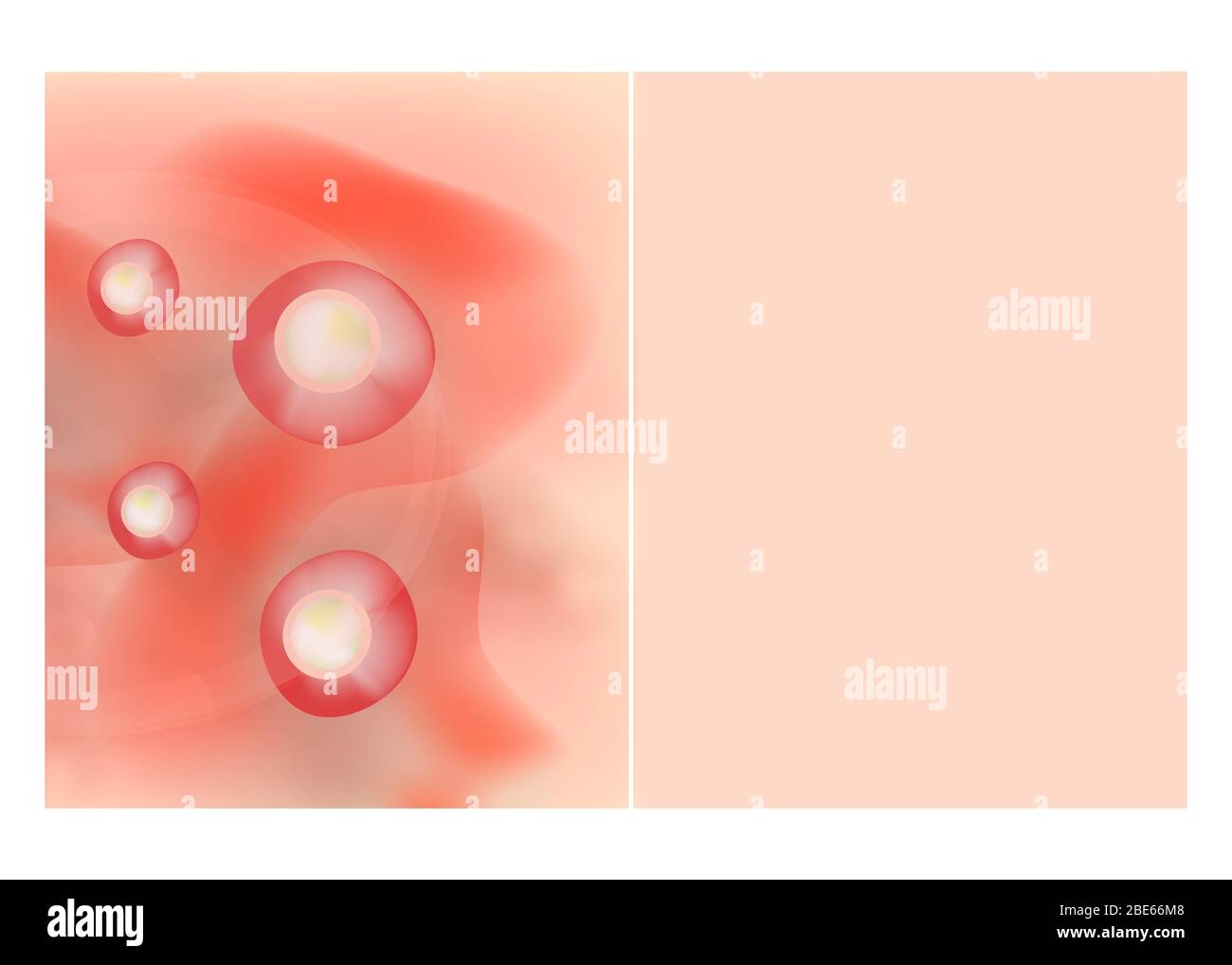 Texture, inflamed pimples and acne. Before After acne cysts. Skin ...