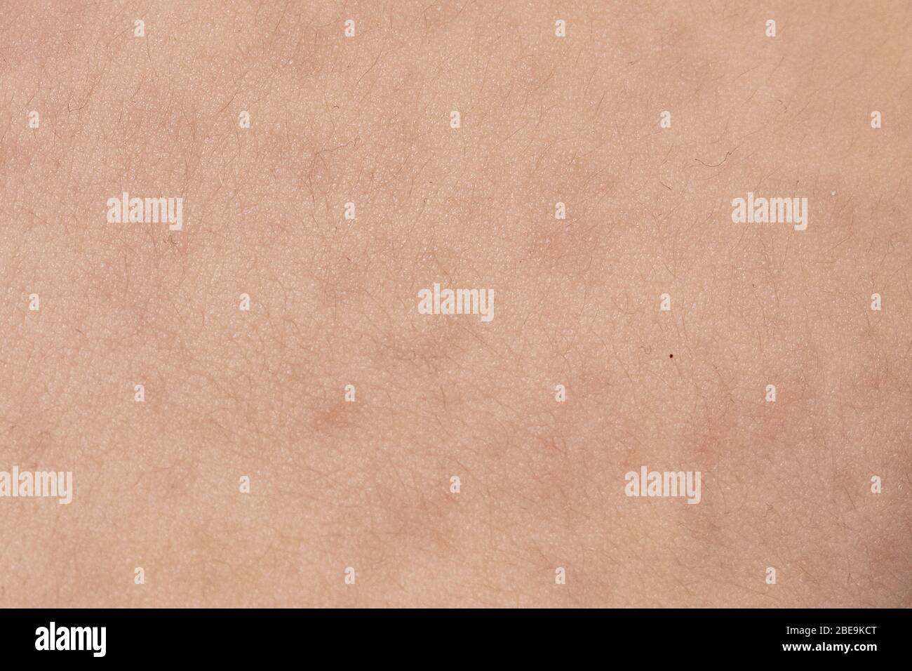 roseola rash a viral rash on the skin of a child Stock Photo - Alamy