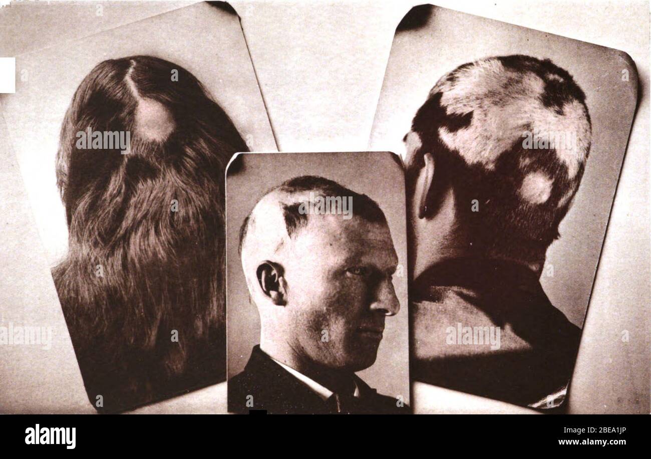 Alopecia alopecia areata hi-res stock photography and images - Alamy