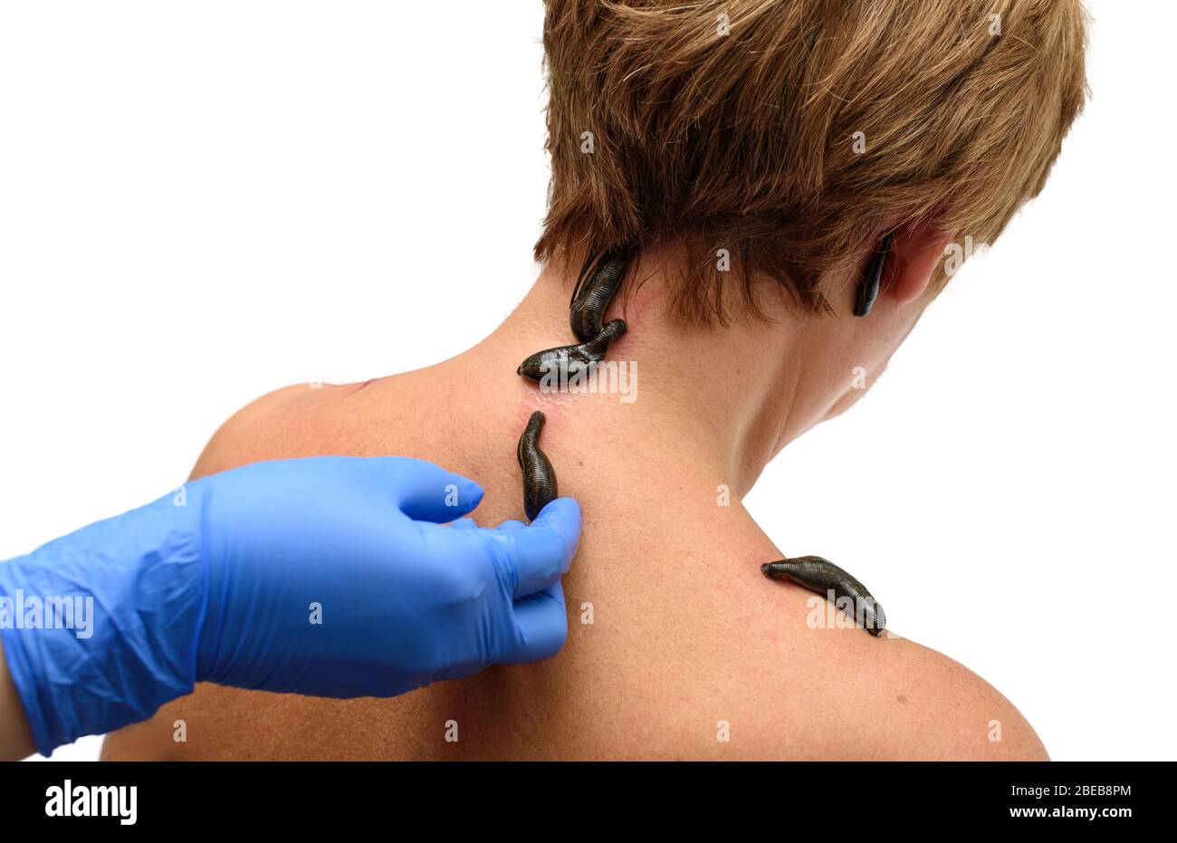 Medicinal leech bite hi-res stock photography and images - Alamy