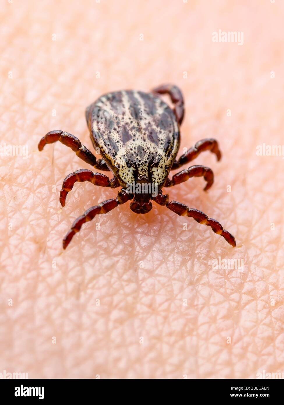 Lyme Disease Infected Tick Insect Crawling on Skin. Encephalitis Virus ...