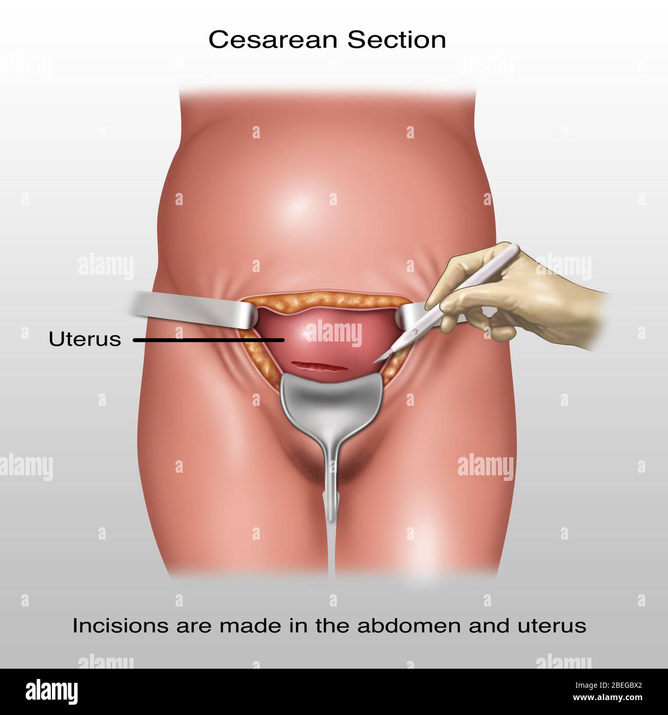 Cesarean Section Incisions, Illustration Stock Photo - Alamy