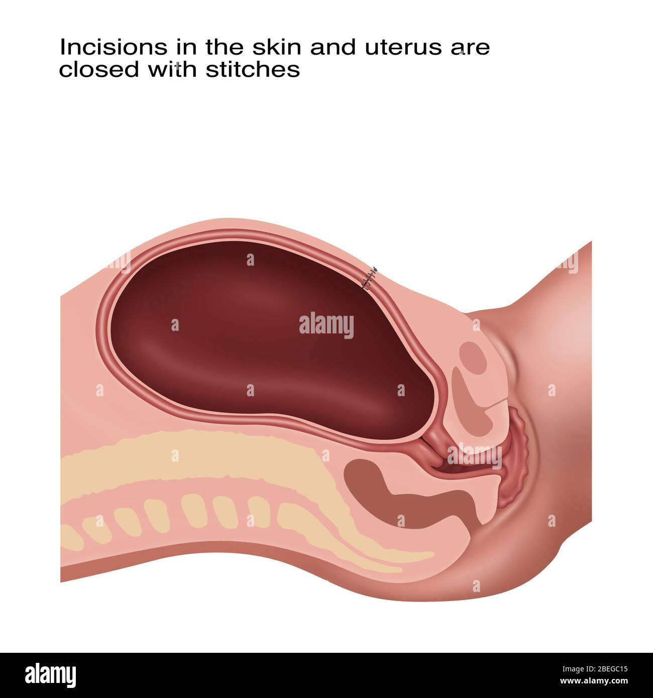 Cesarean Section Diagram