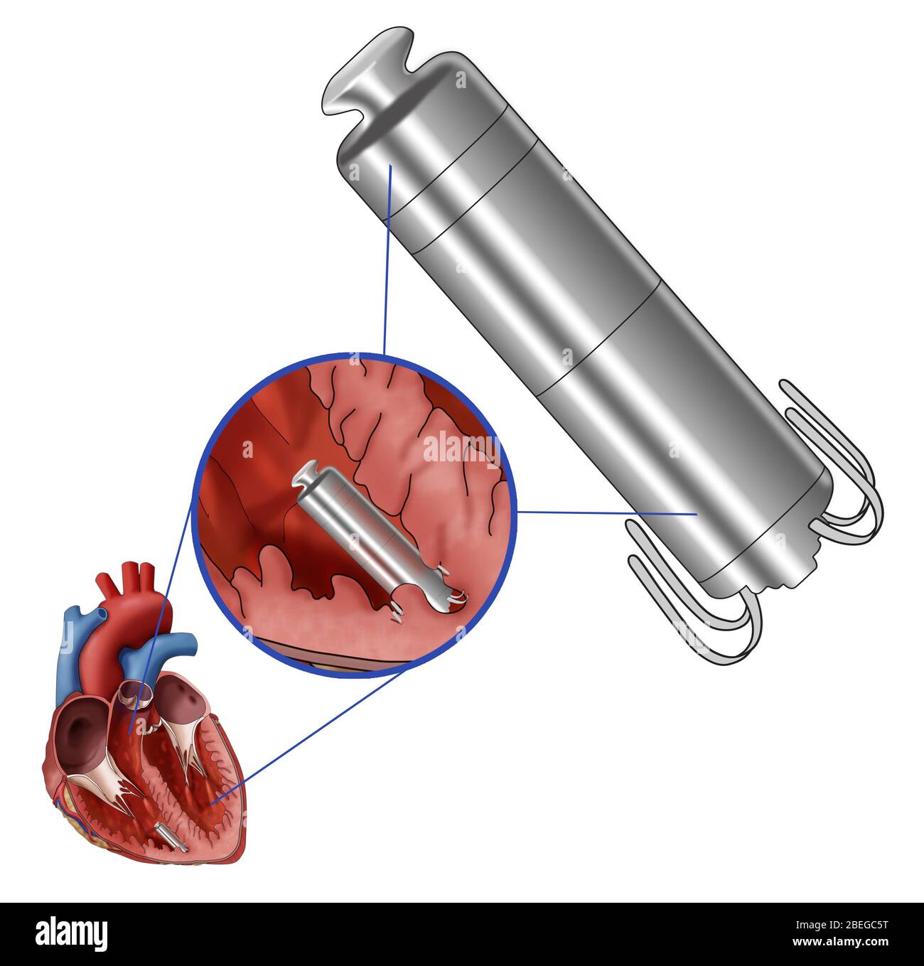 Leadless Pacemaker, Illustration Stock Photo - Alamy