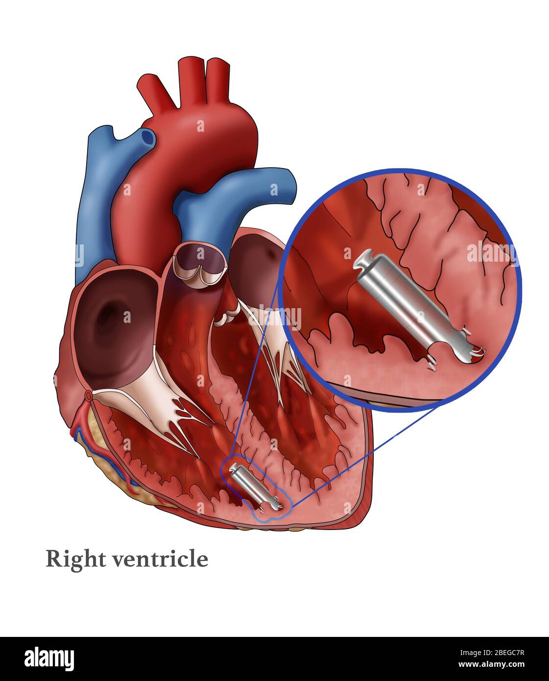 Leadless pacemaker Cut Out Stock Images & Pictures - Alamy