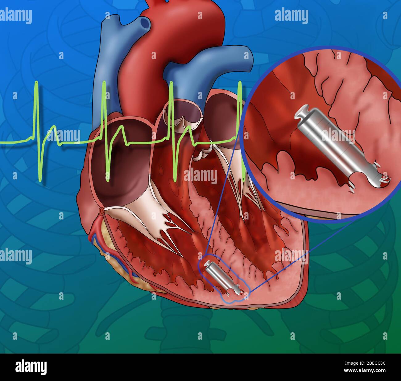 Leadless Pacemaker, Illustration Stock Photo - Alamy