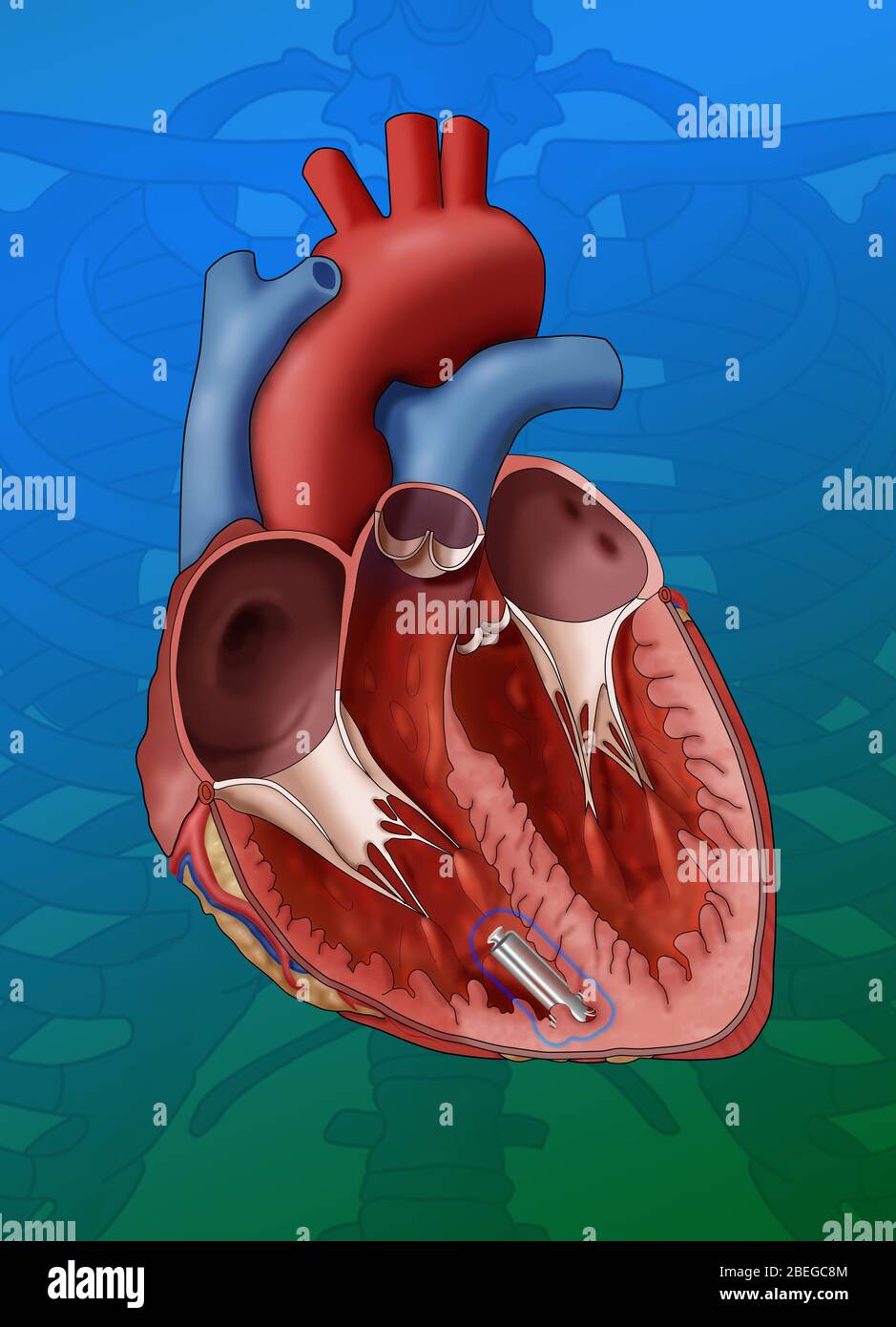 Leadless Pacemaker, Illustration Stock Photo - Alamy