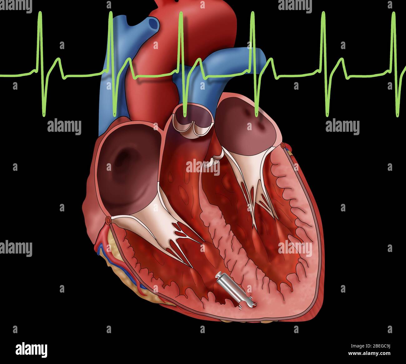 Leadless Pacemaker, Illustration Stock Photo - Alamy