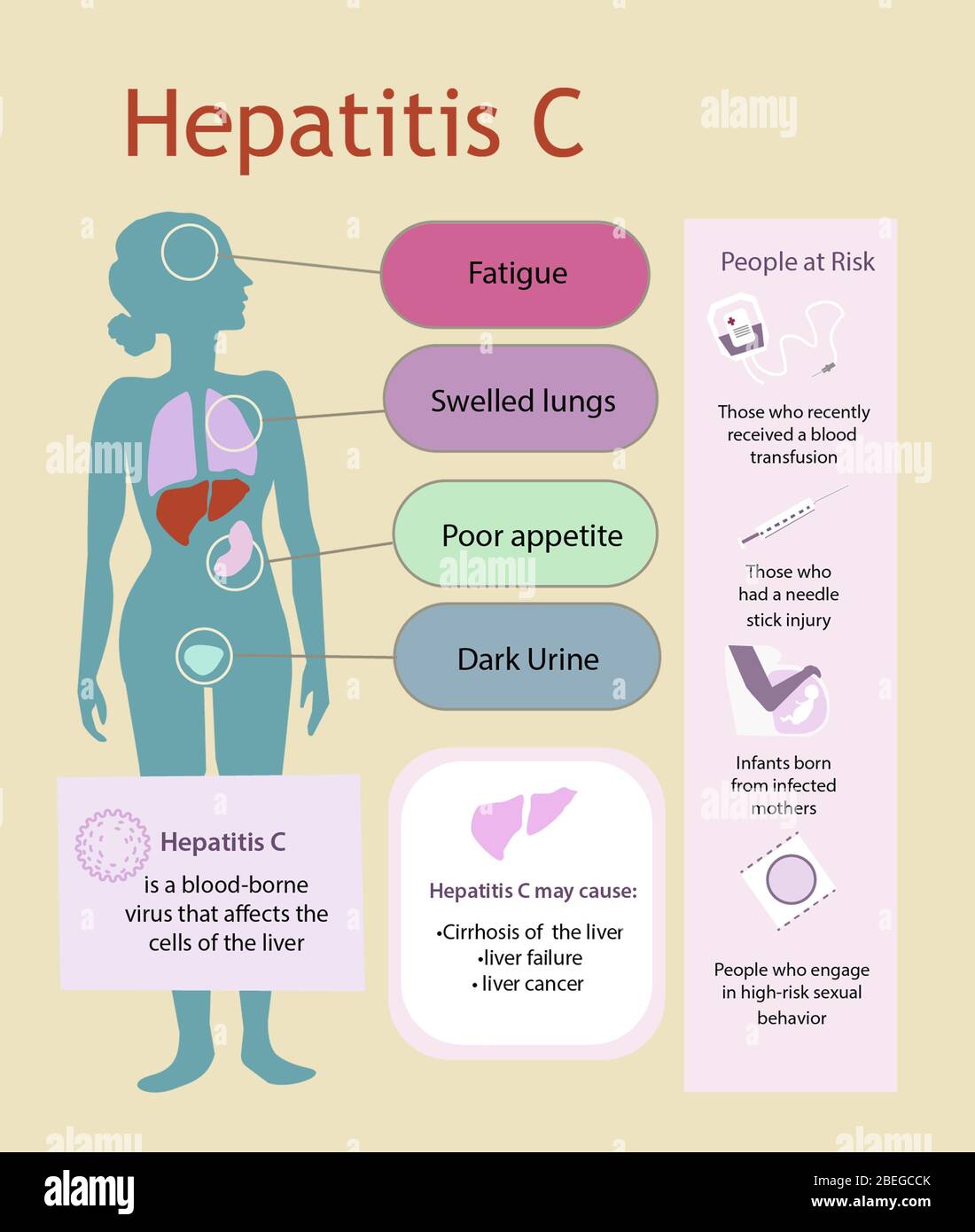 Hepatitis C, Illustration Stock Photo - Alamy