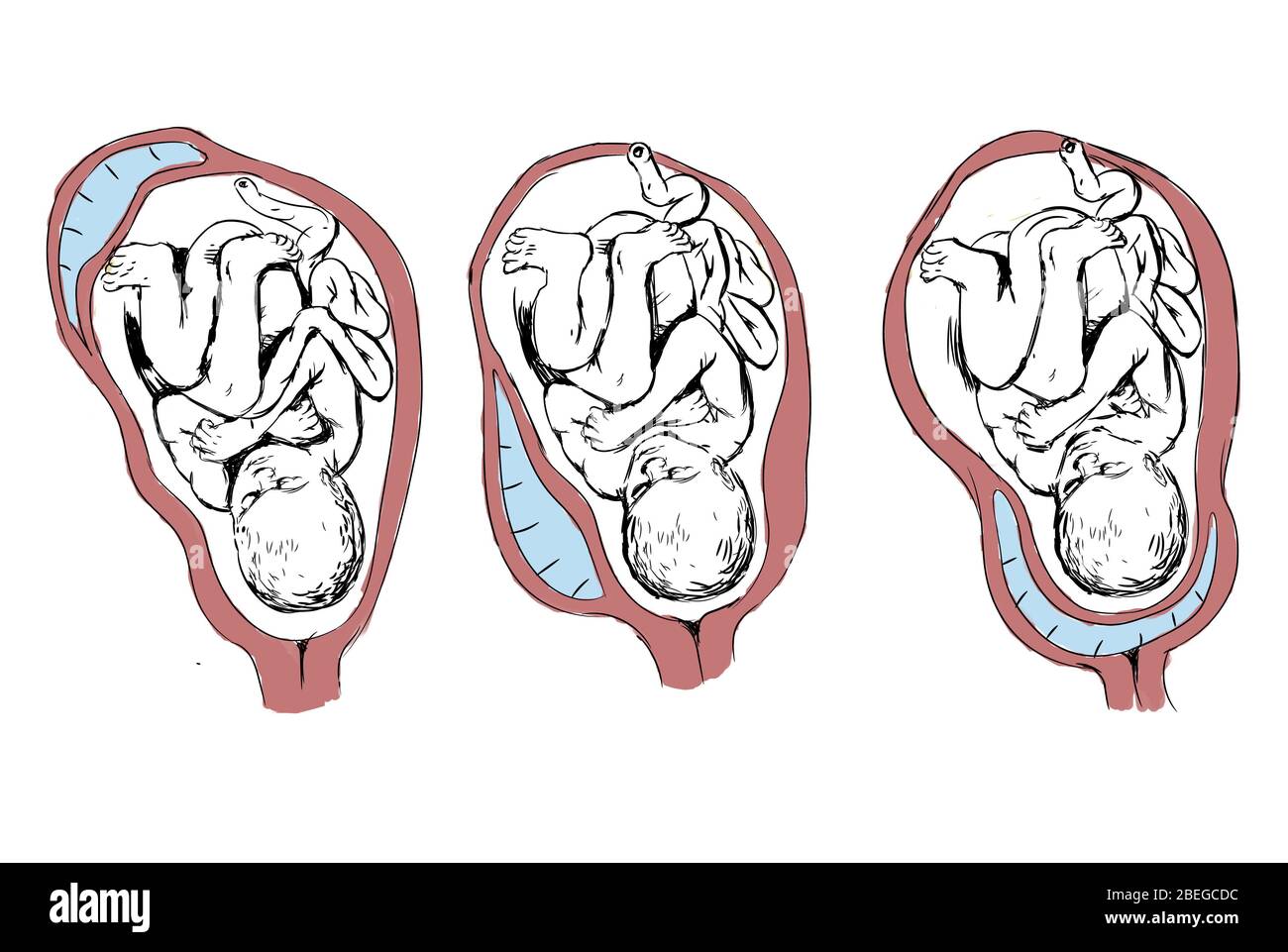 Placenta previa hi-res stock photography and images - Alamy