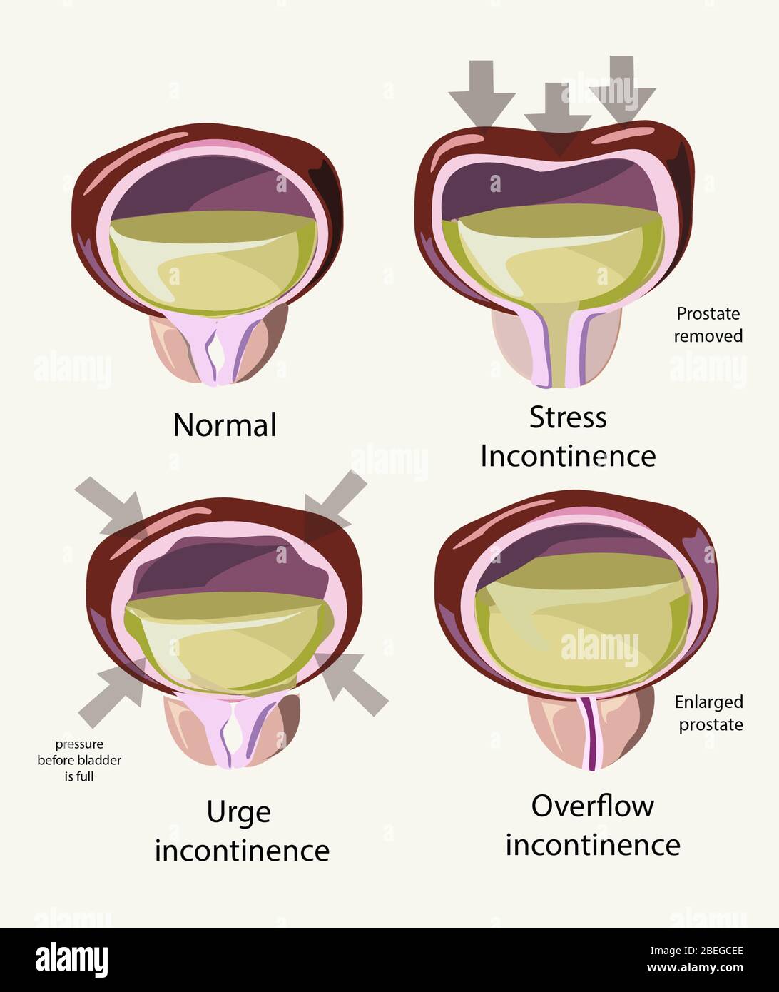 Urinary Incontinence, Illustration Stock Photo - Alamy