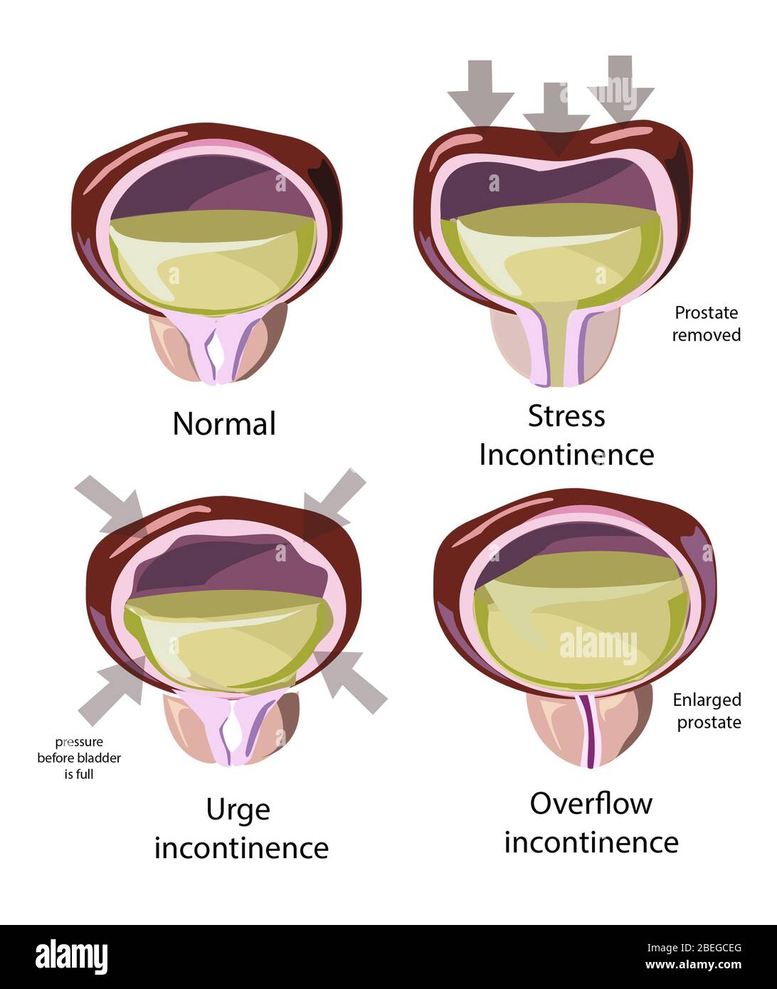 Urinary Incontinence, Illustration Stock Photo - Alamy