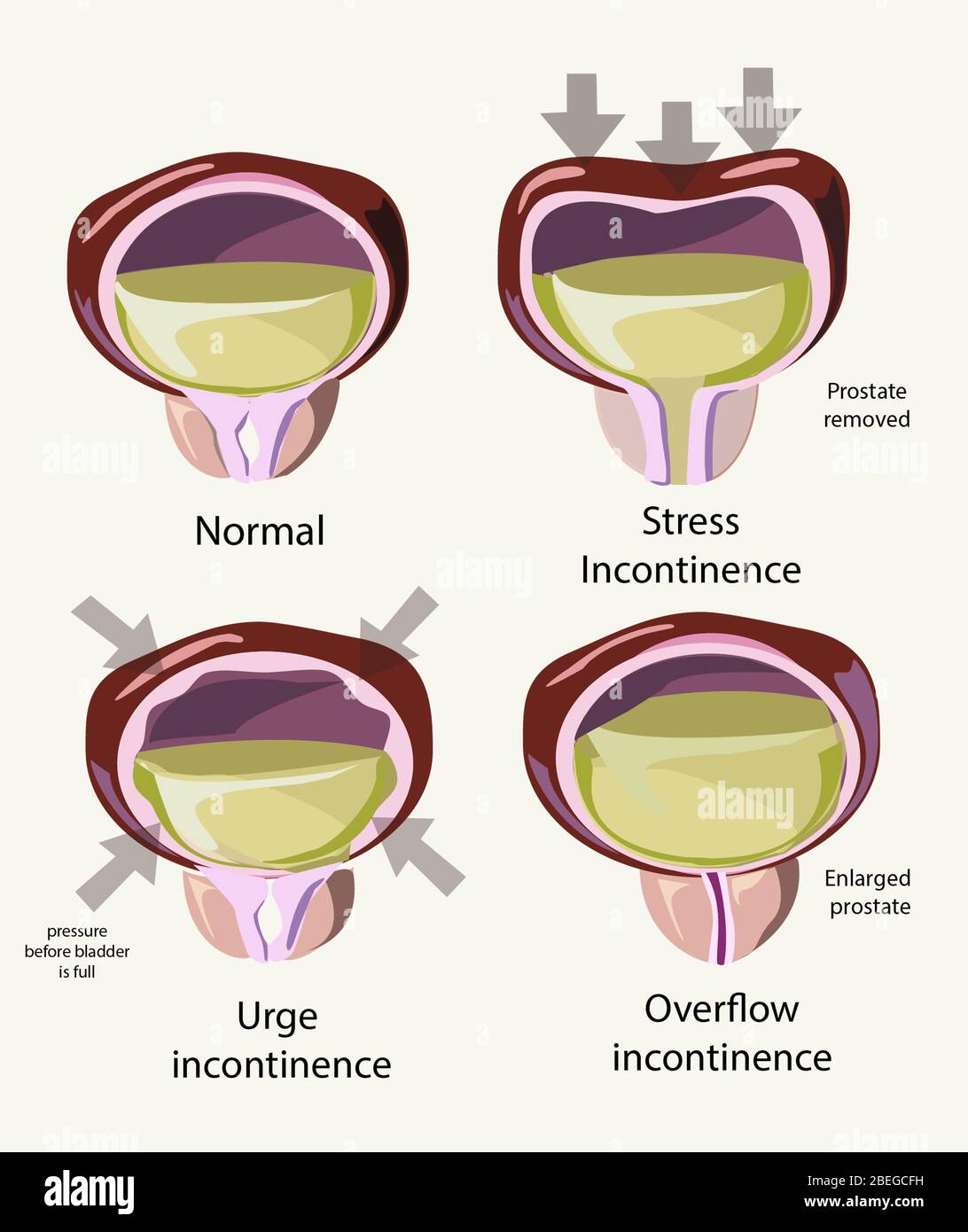 Urinary Incontinence, Illustration Stock Photo - Alamy