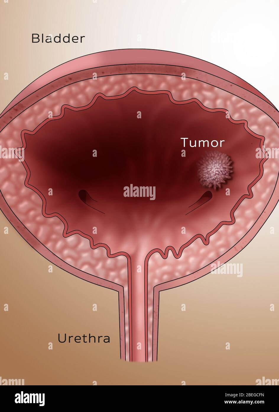 Bladder Cancer, Illustration Stock Photo - Alamy