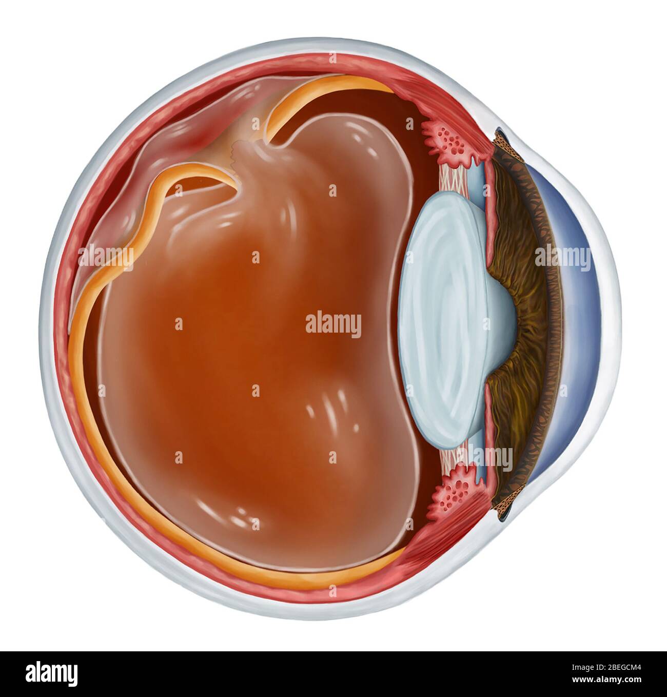Retinal detachment hi-res stock photography and images - Alamy