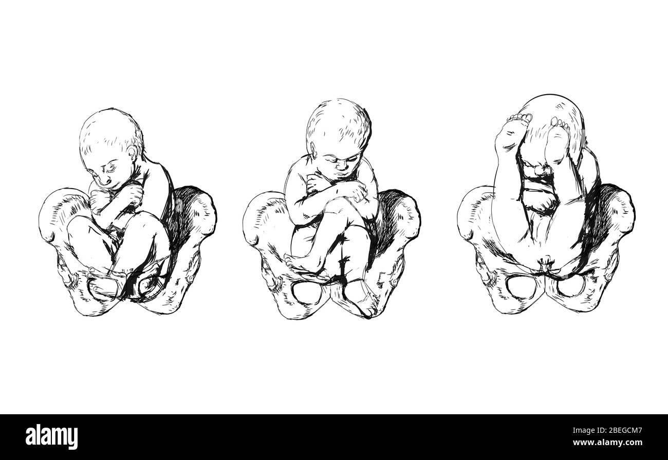 Breech Position High Resolution Stock Photography and Images - Alamy