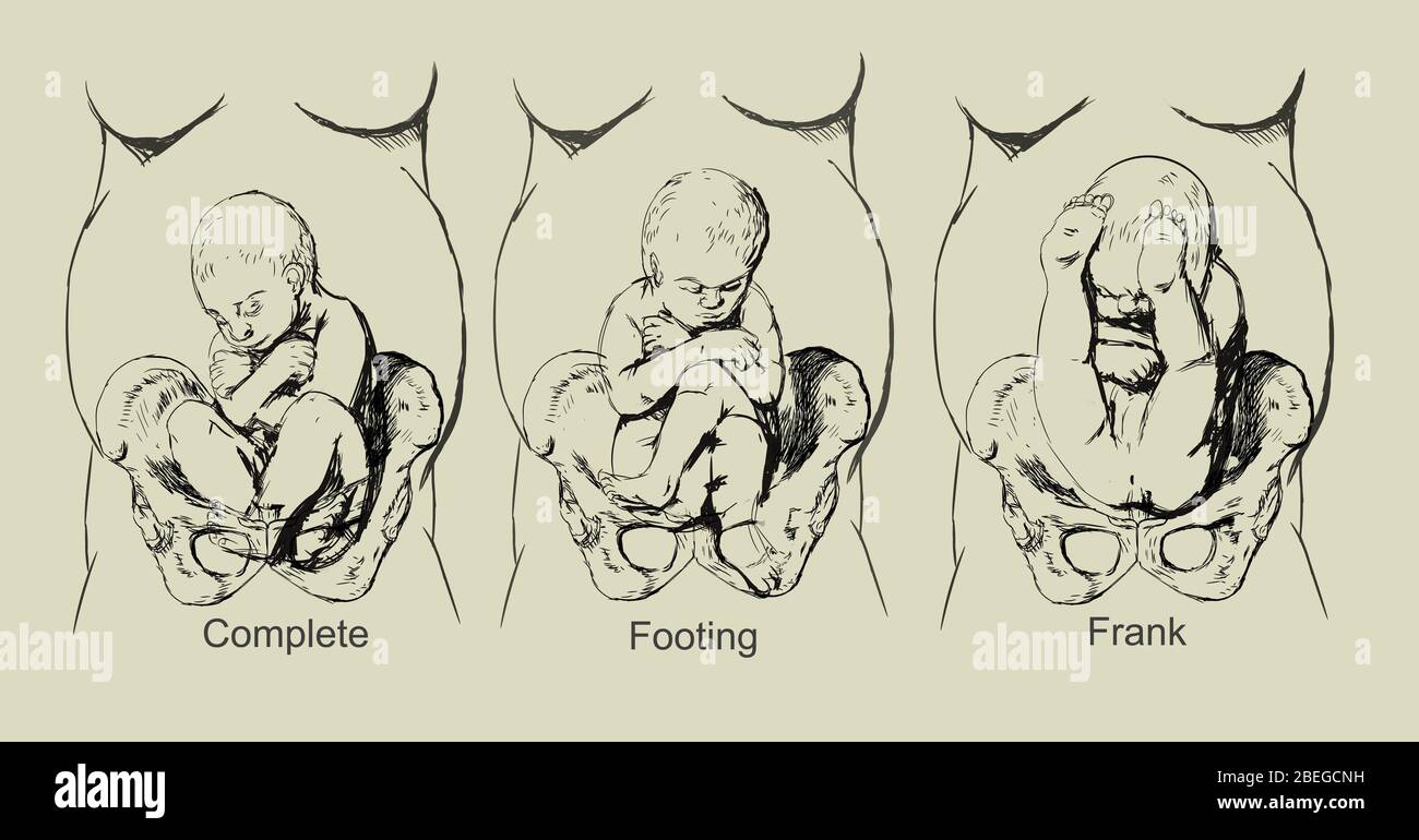 Breech baby hi-res stock photography and images - Alamy