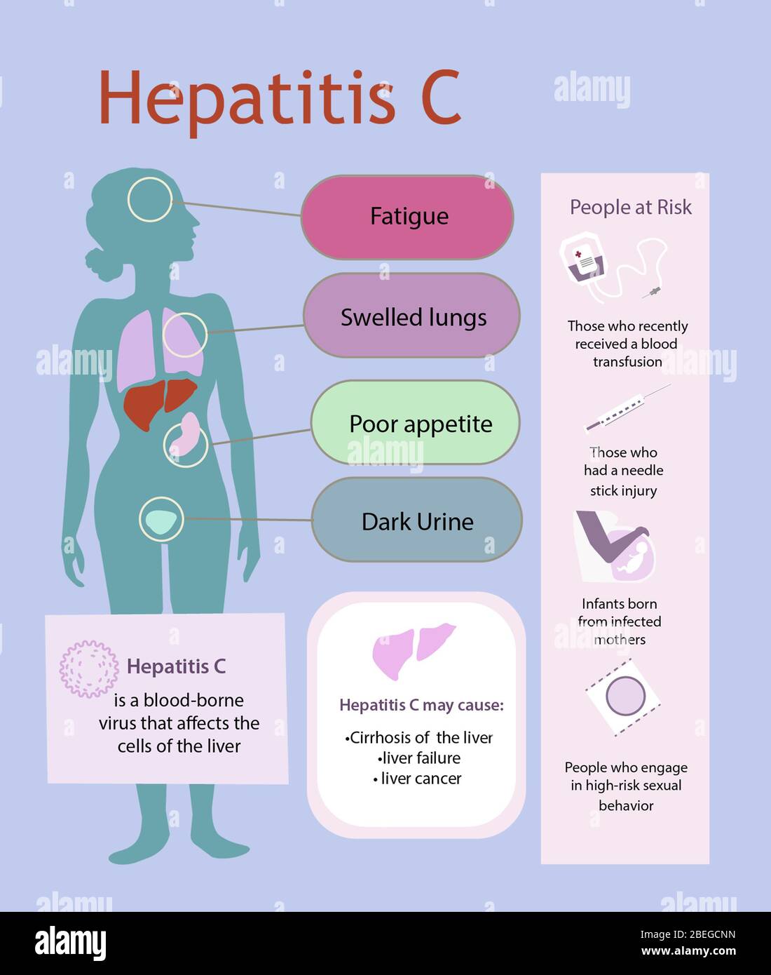 Hepatitis C, Illustration Stock Photo - Alamy