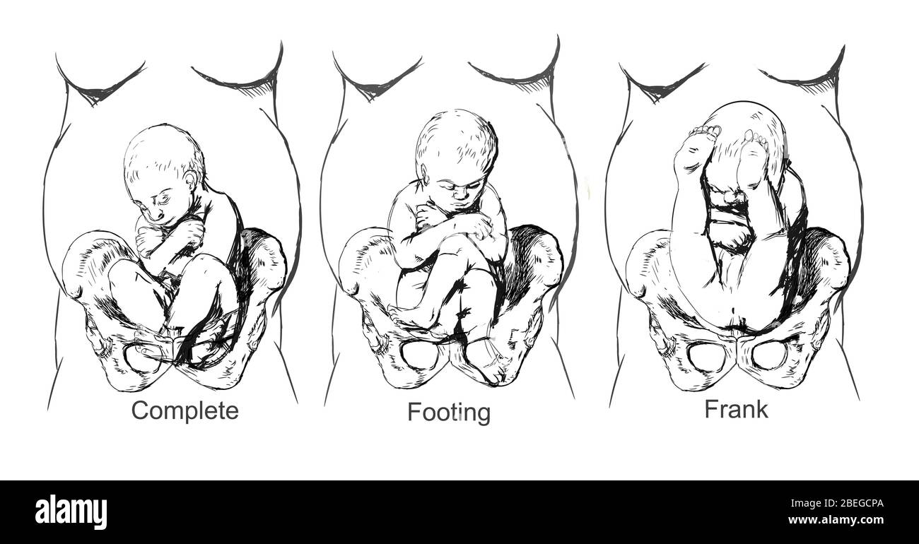 Baby birth positions hi-res stock photography and images - Alamy