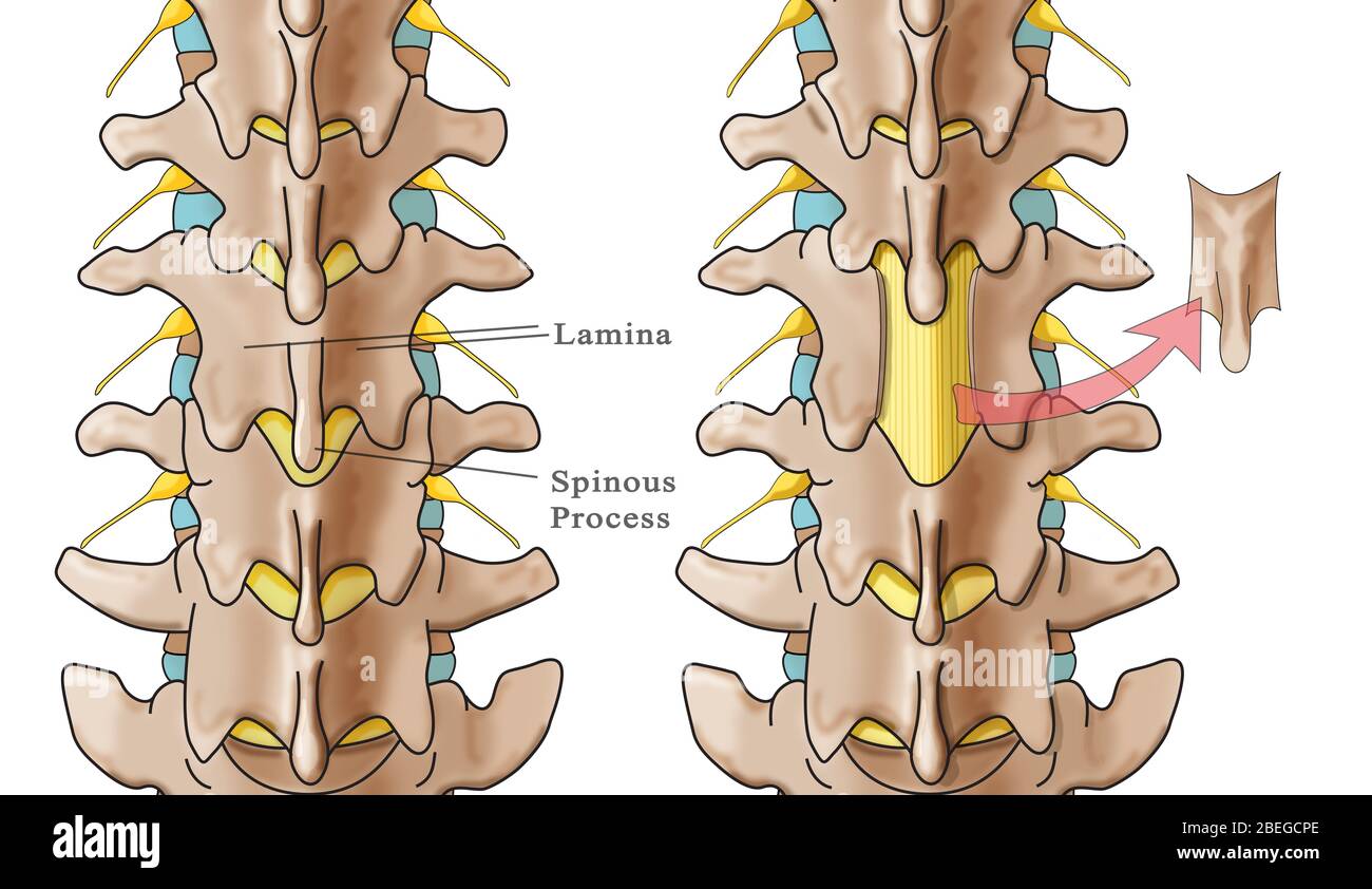 Lumbar laminectomy hi-res stock photography and images - Alamy