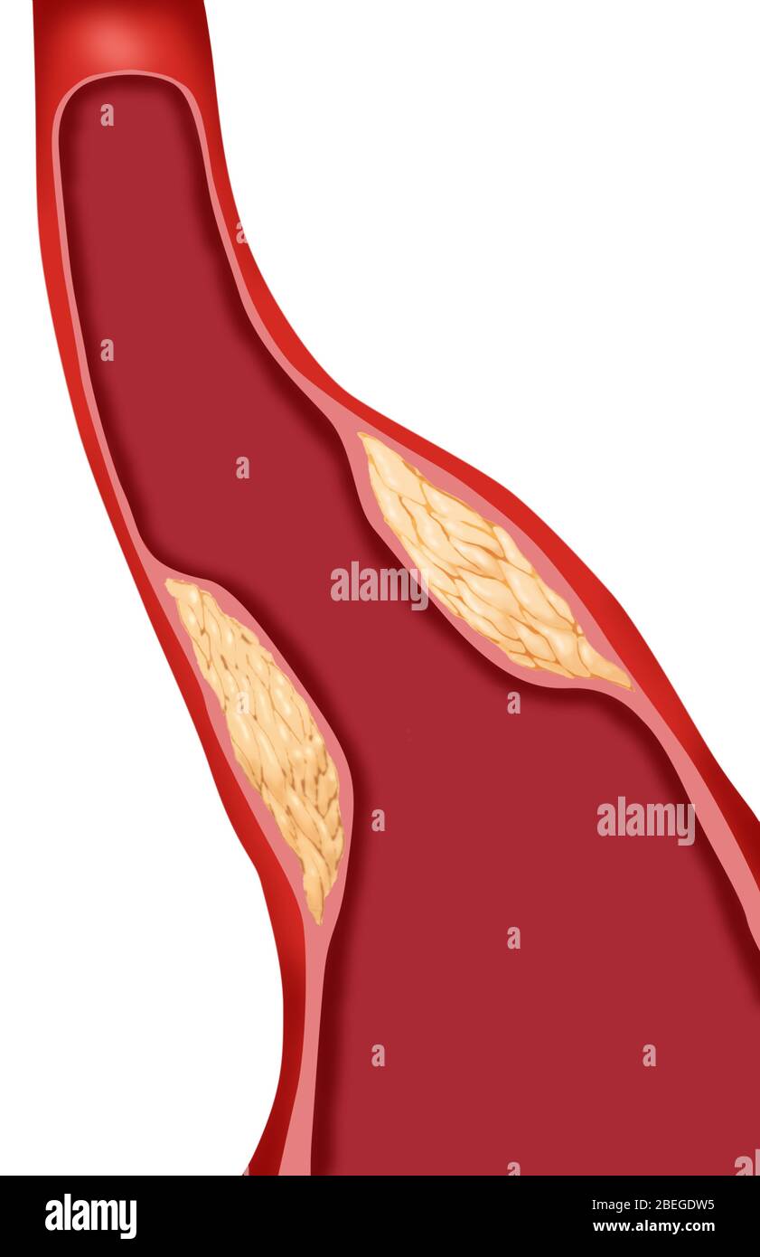 Balloon Angioplasty, 3 of 4 Stock Photo - Alamy