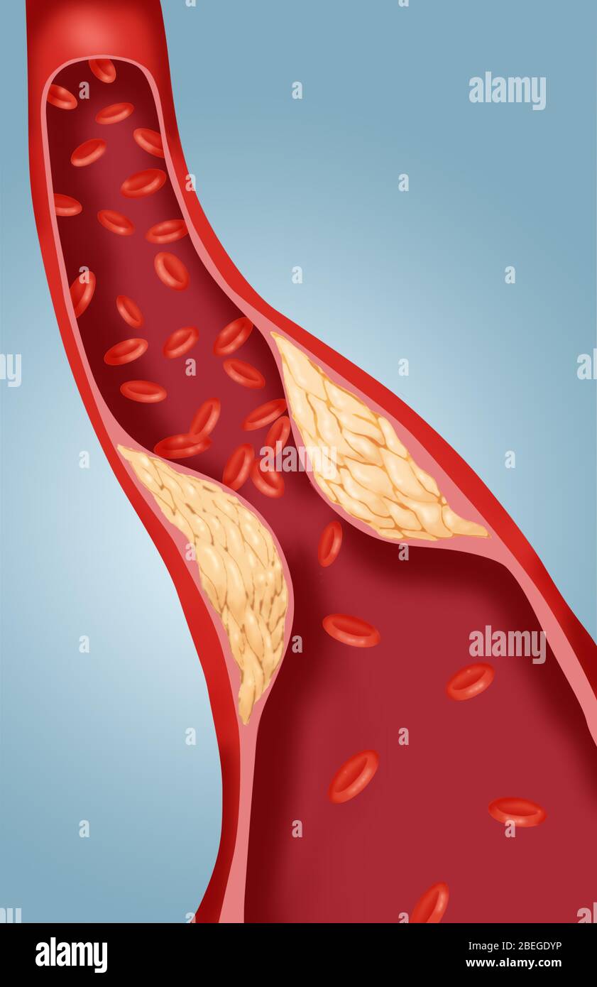 Atherosclerosis plaque hi-res stock photography and images - Alamy