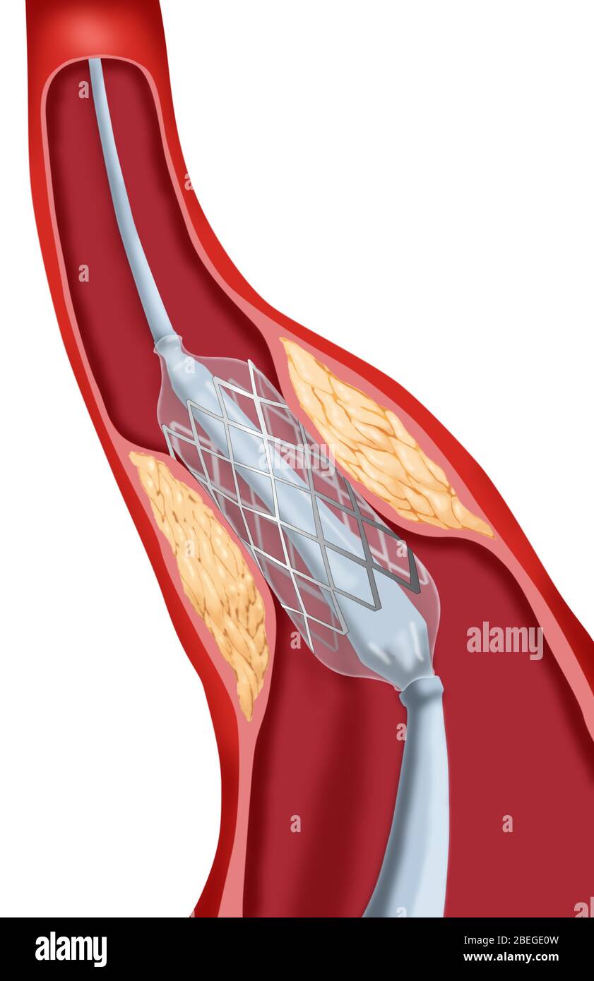 Coronary artery stent hi-res stock photography and images - Alamy