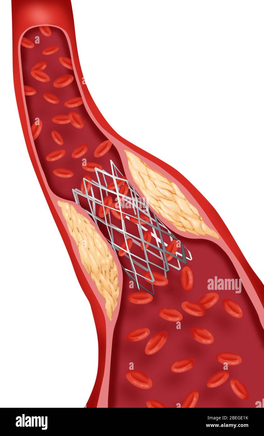 Coronary stent hi-res stock photography and images - Alamy