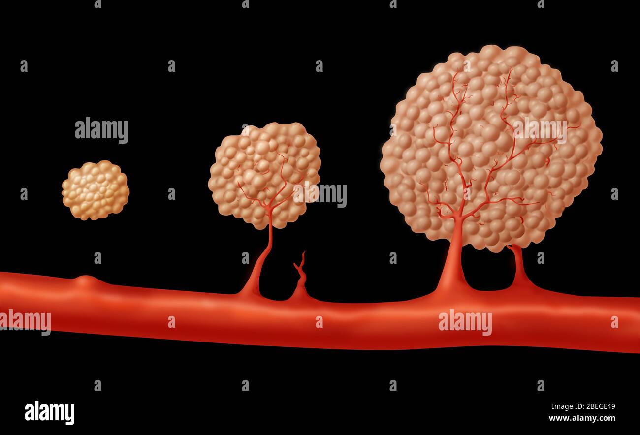 Angiogenesis hi-res stock photography and images - Alamy