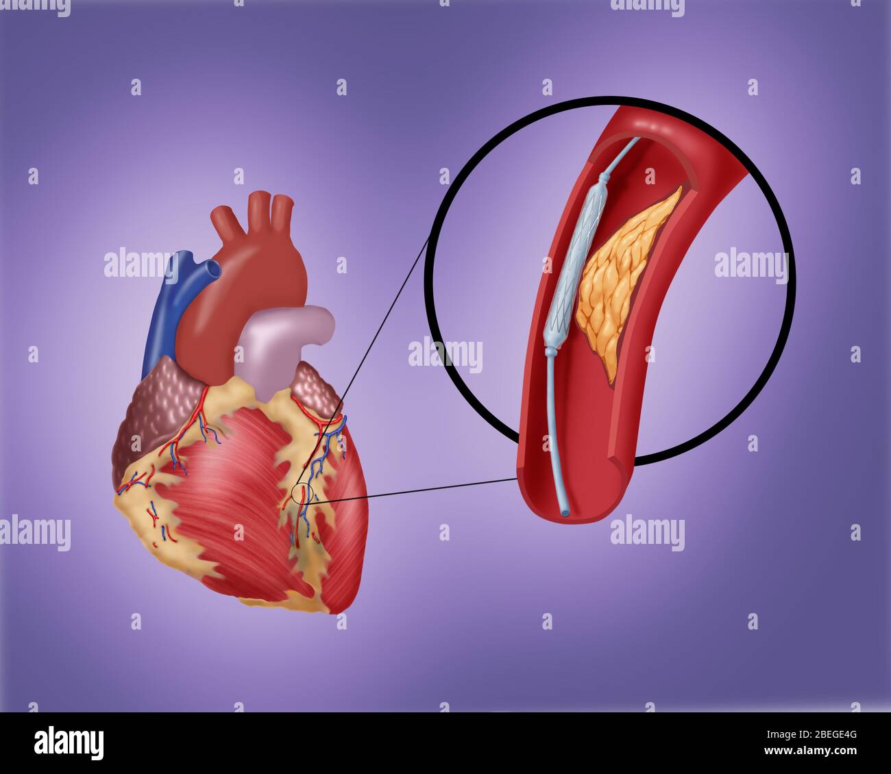 Angioplasty with Stenting, 1 of 4 Stock Photo - Alamy