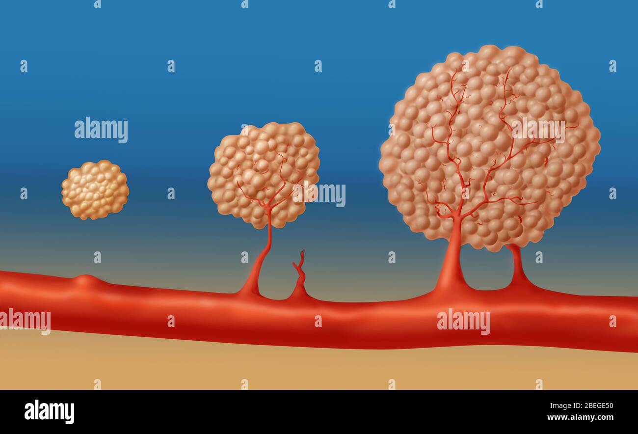 Angiogenesis hi-res stock photography and images - Alamy