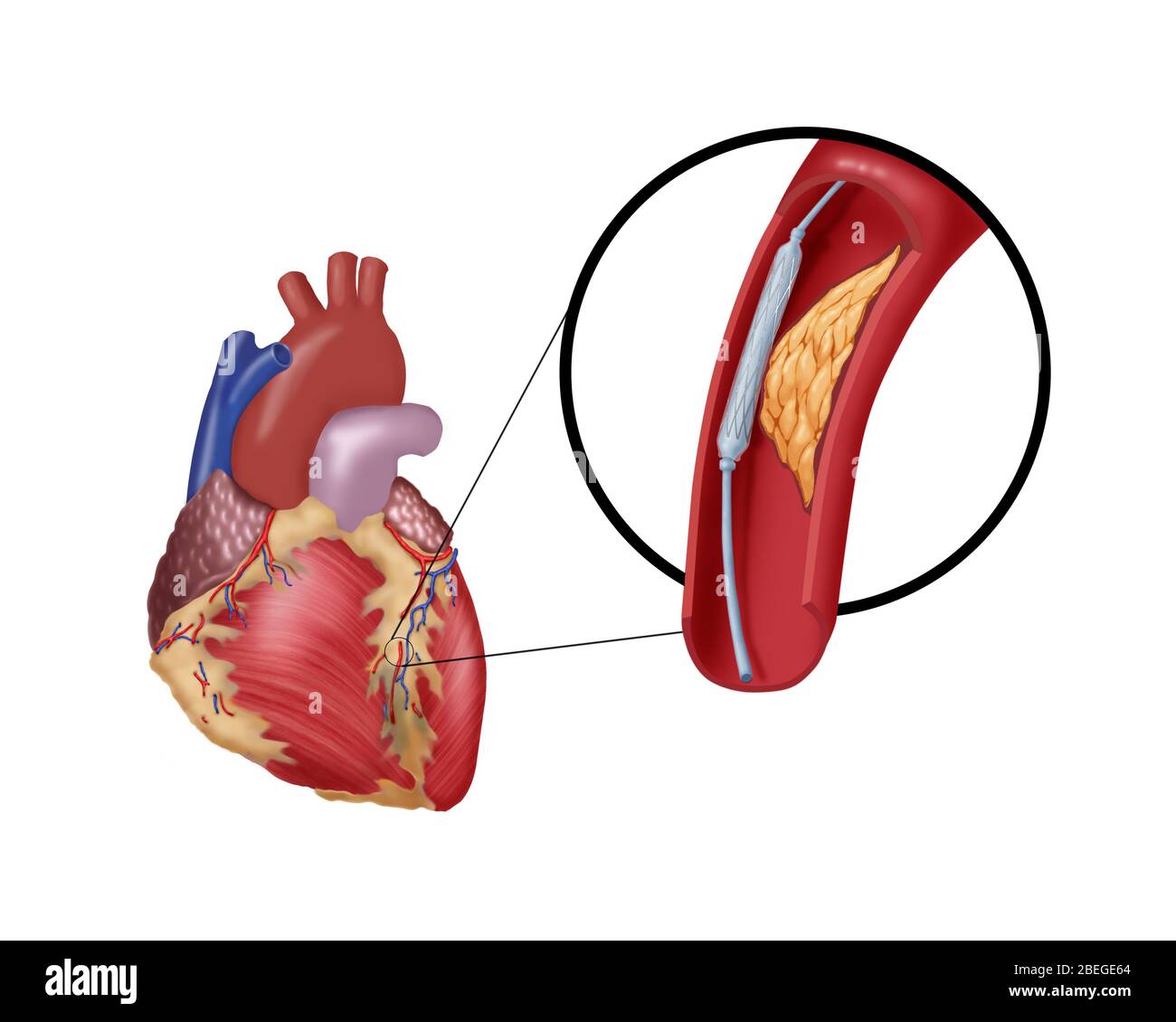 Angioplasty with Stenting, 1 of 4 Stock Photo - Alamy