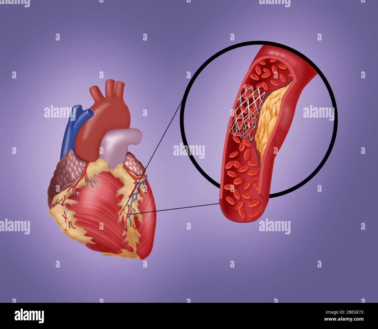Coronary stent system hi-res stock photography and images - Alamy