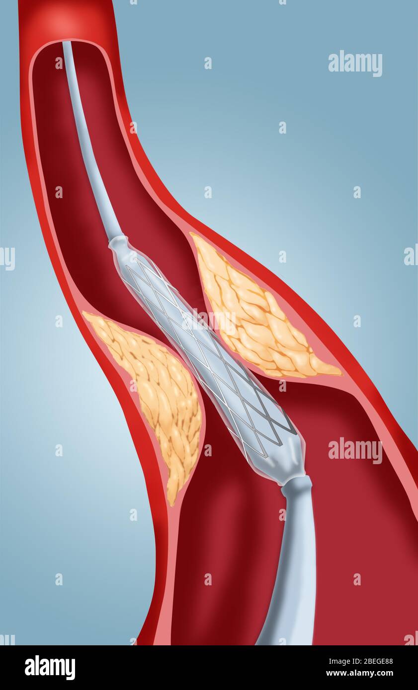 Heart stent hi-res stock photography and images - Alamy