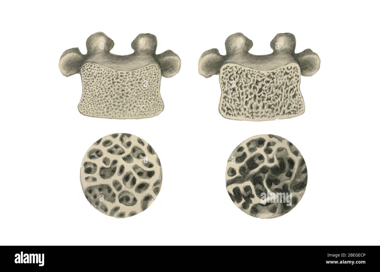 Osteoporosis and Normal Bone Comparison Stock Photo - Alamy