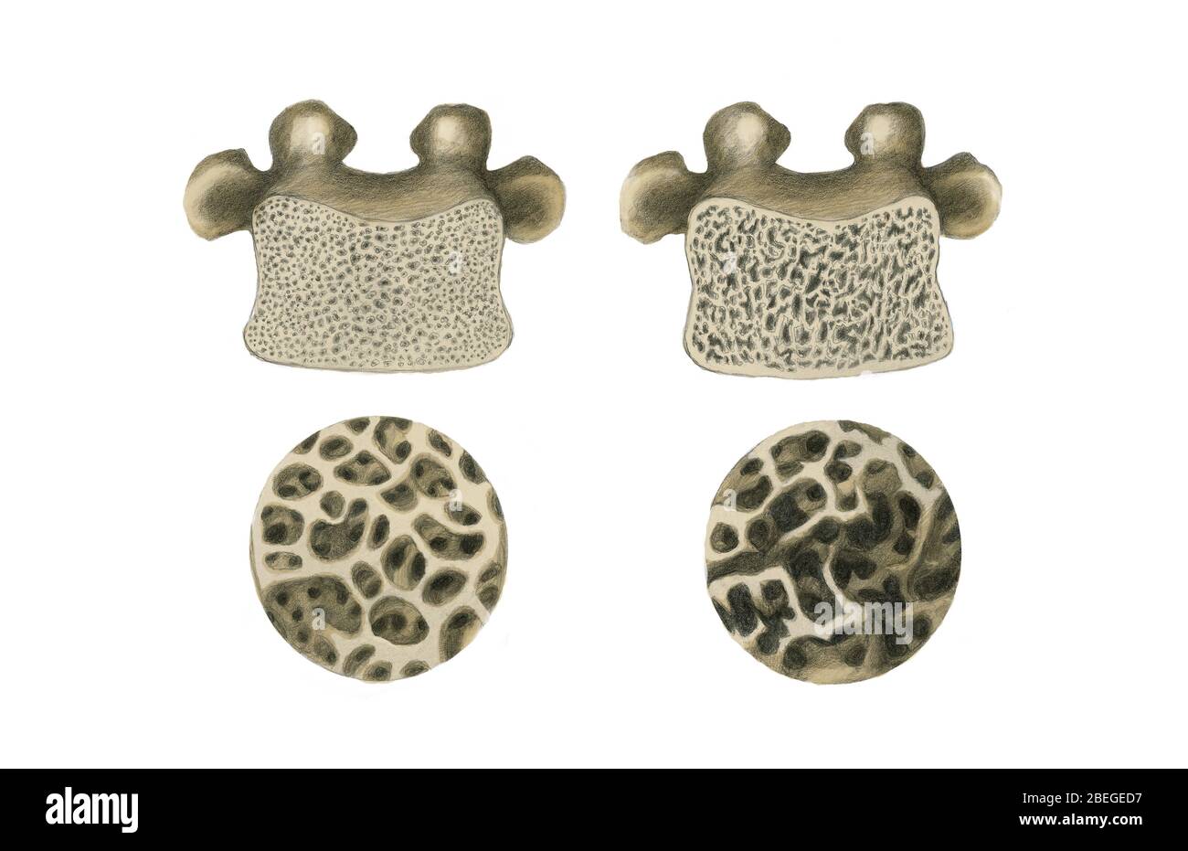 Osteoporosis and Normal Bone Comparison Stock Photo - Alamy